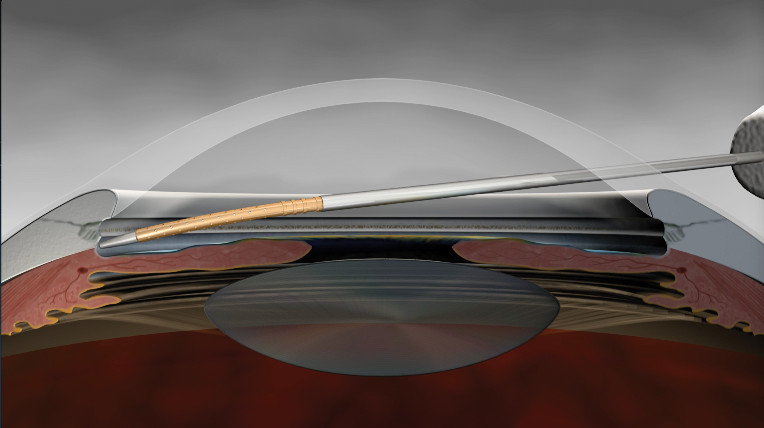 Evitar los fármacos en fases iniciales del glaucoma ya es posible ...