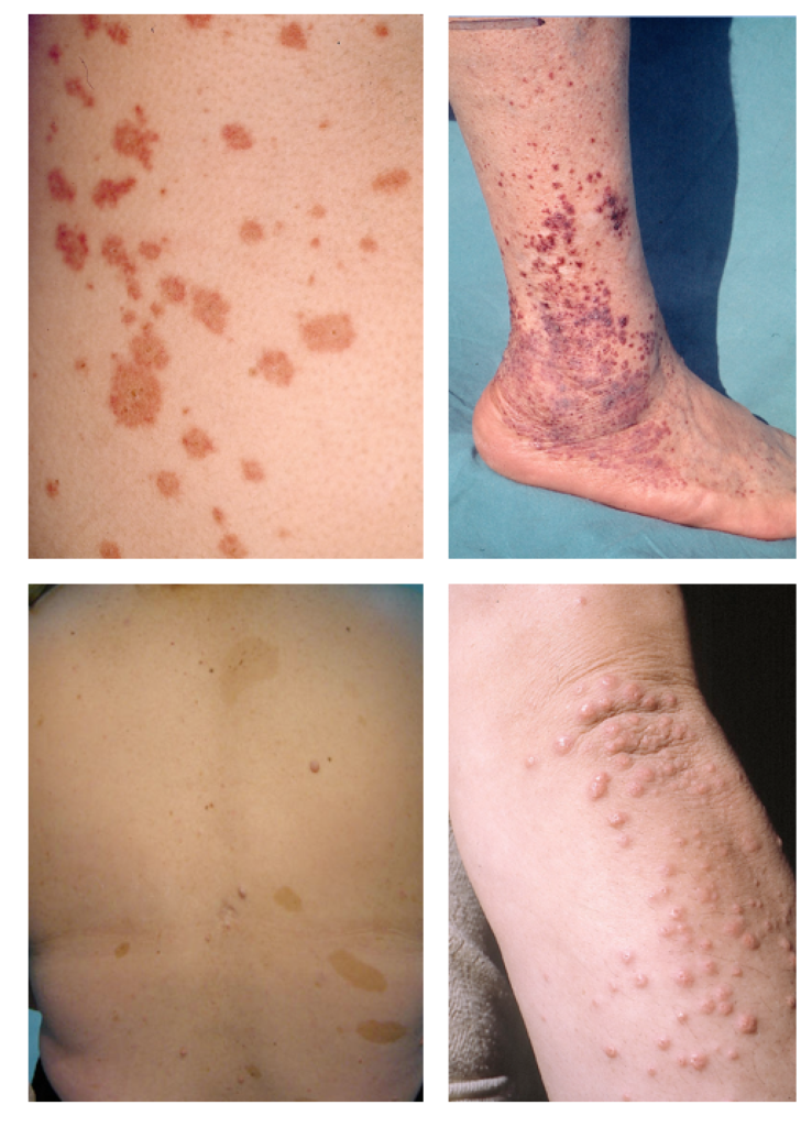 II. Las lesiones elementales de la piel – Salud y Medicina