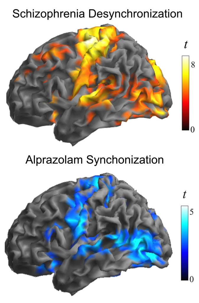 Descubren una clase de neuronas defectuosa en el cerebro de las ...
